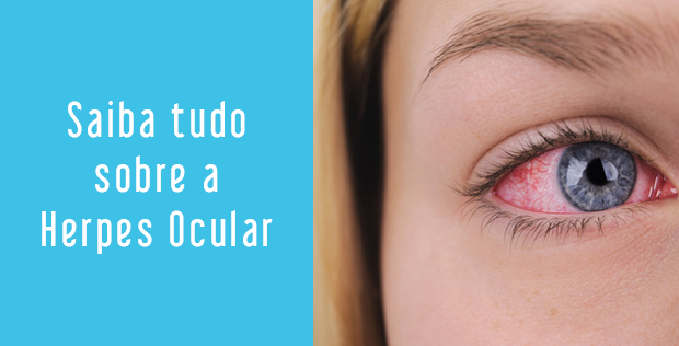 O que é Herpes Ocular | Oculari Hospital Oftalmológico
