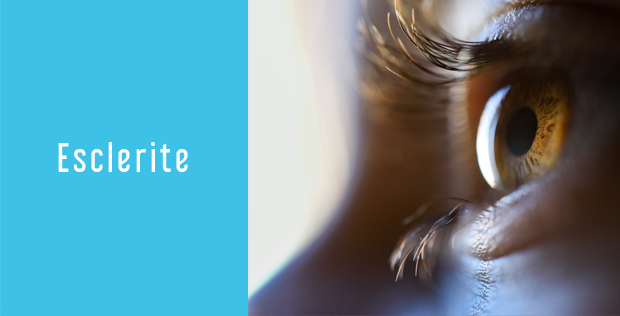 O que é a Esclerite | Oculari Hospital Oftalmológico